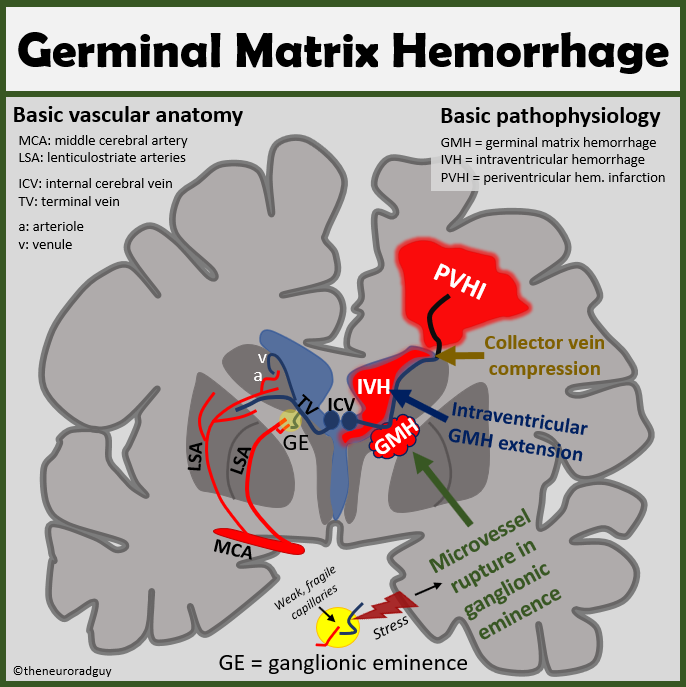Germinal Matrix Hemorrhage Diagram