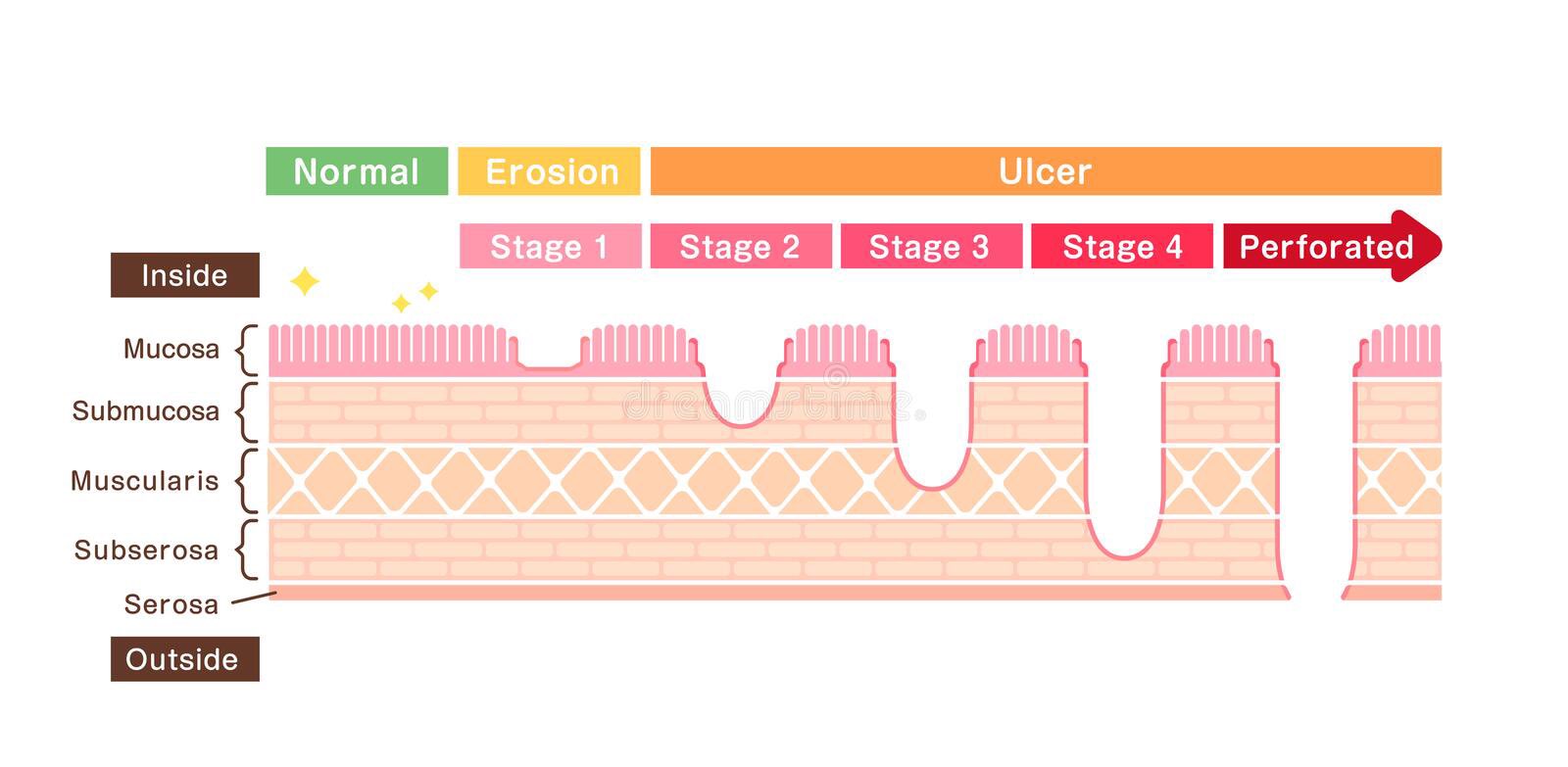 Erosion Skin Vs Ulcer
