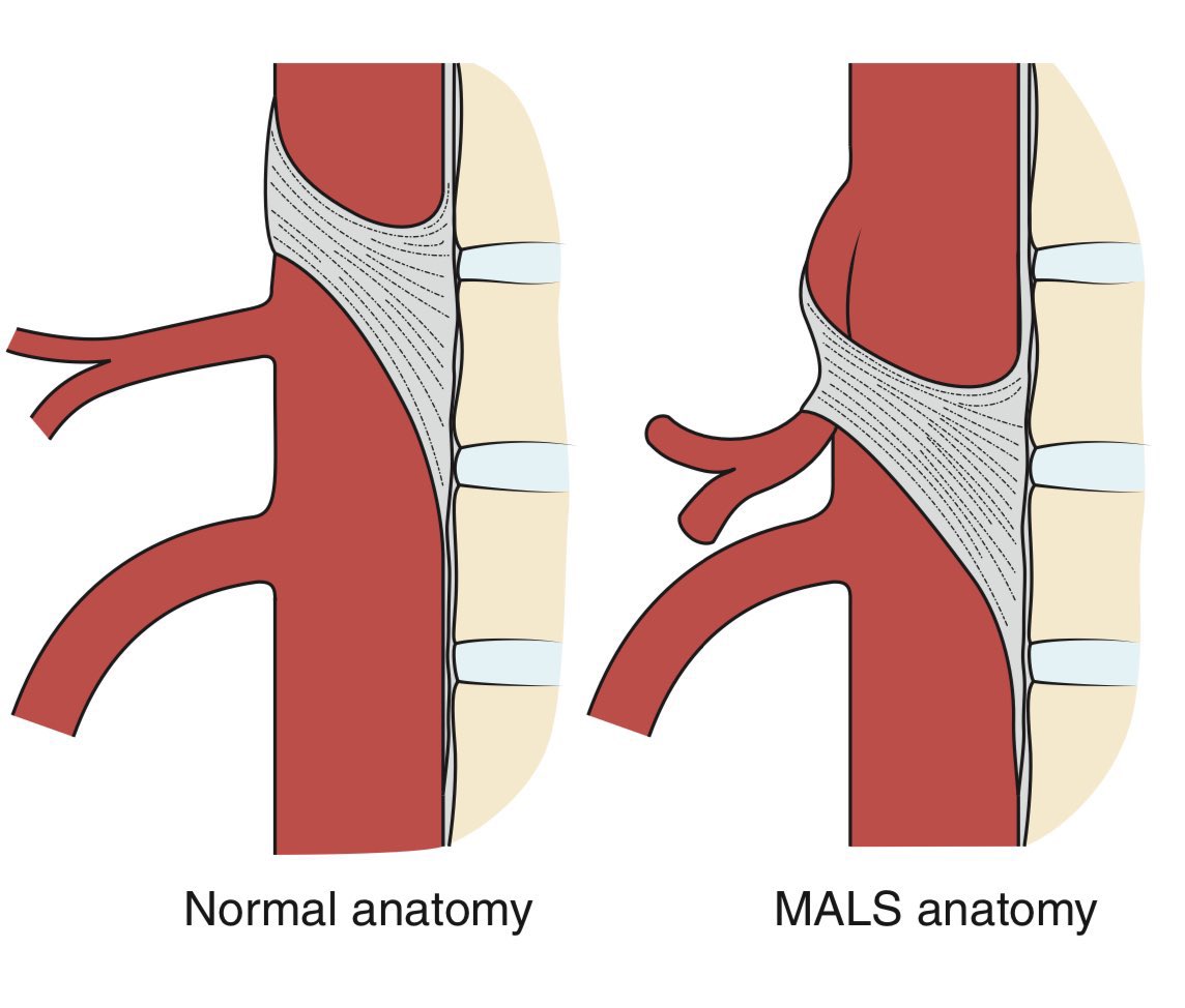 Arcuate Ligament Syndrome
