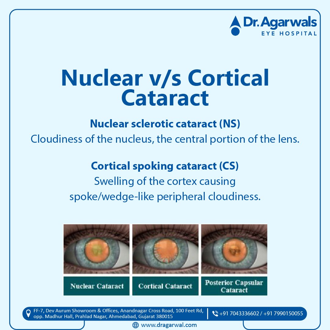 Nuclear Cataract