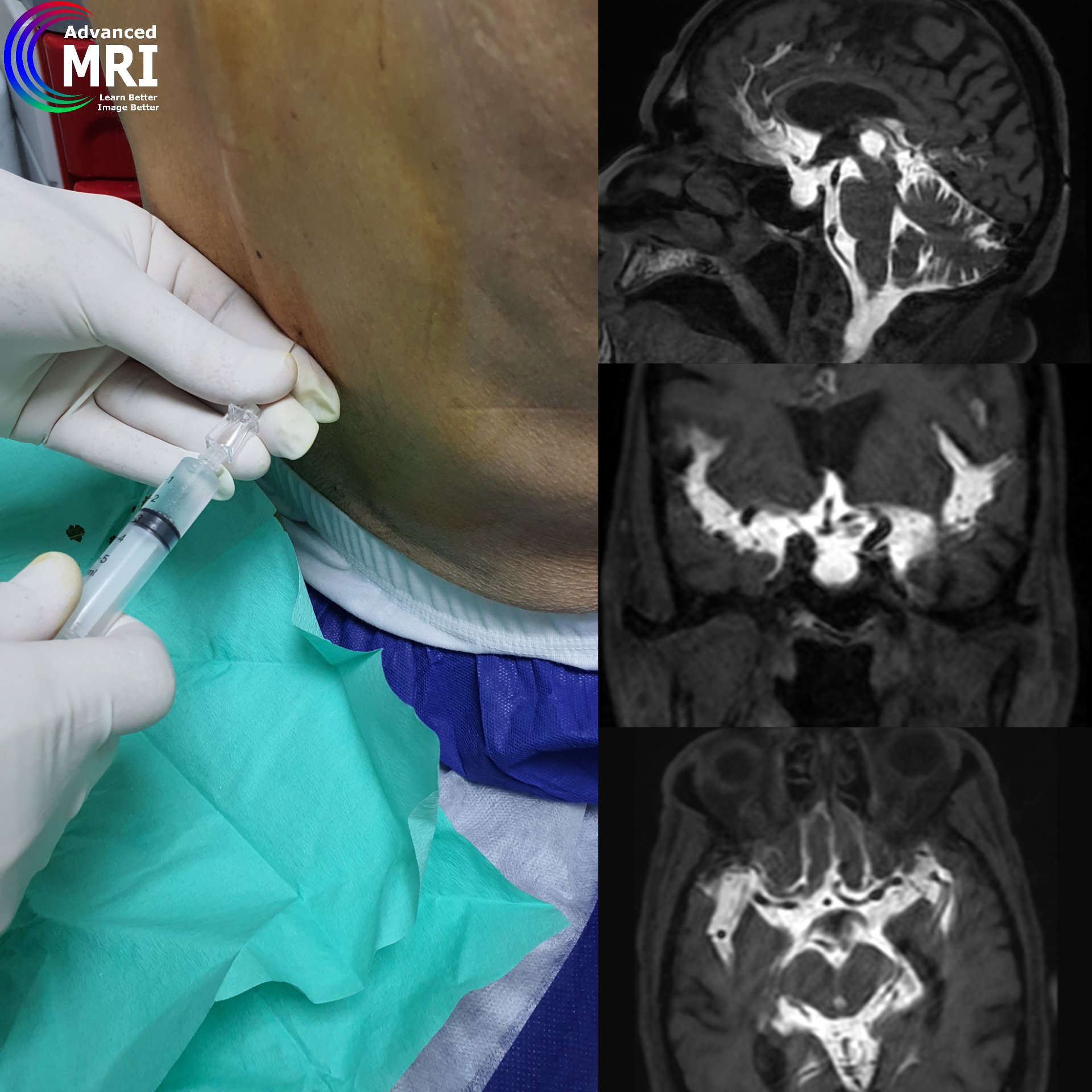 Gadolinium Injection