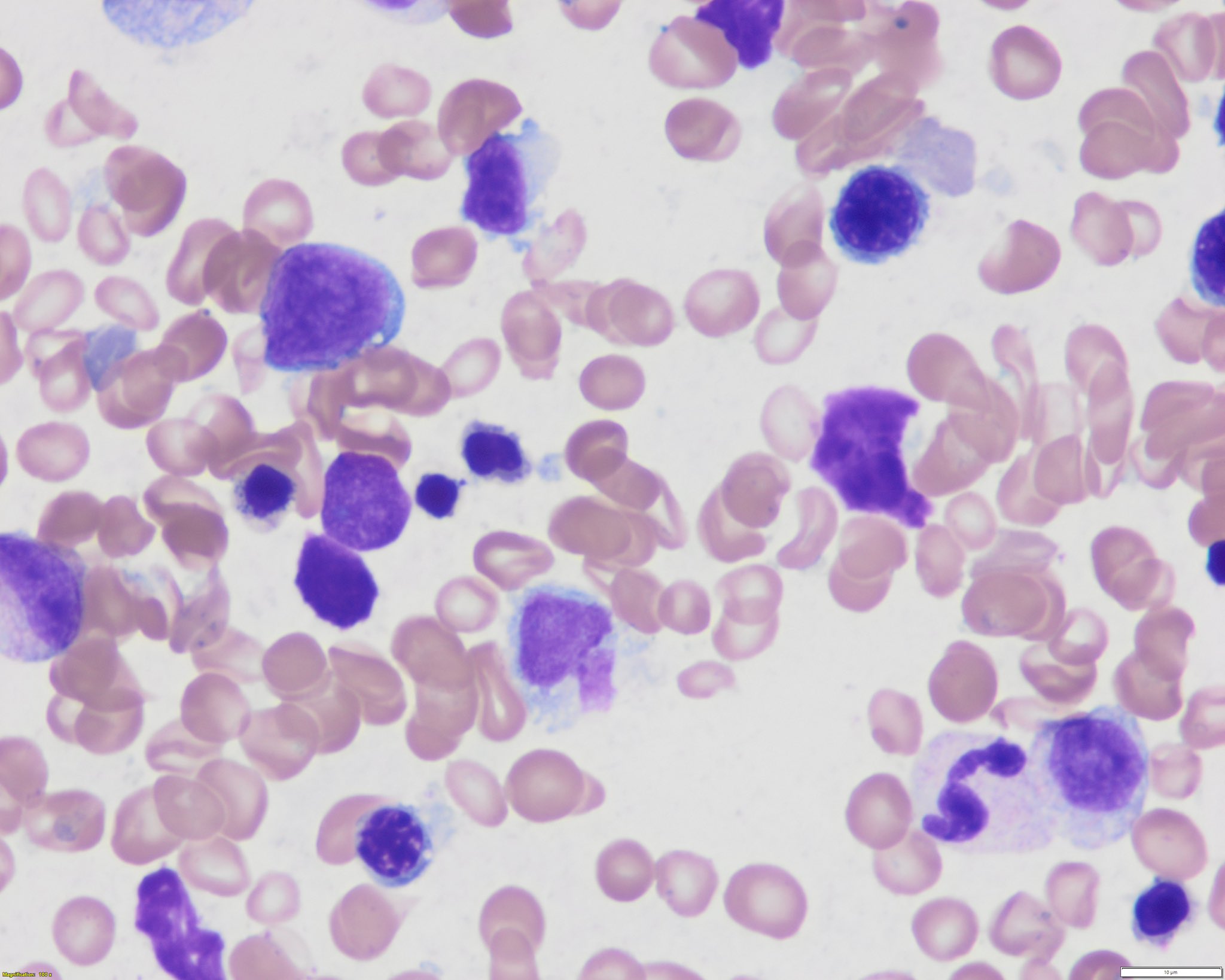Ringed Sideroblasts Vs Basophilic Stippling
