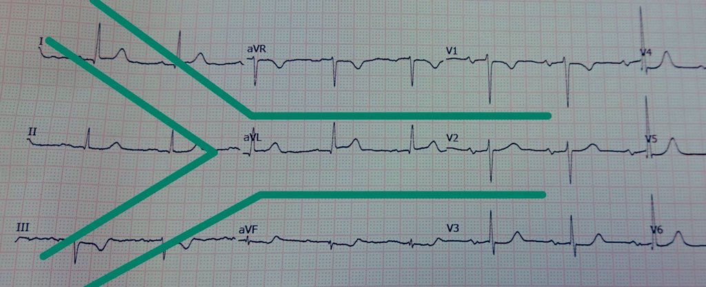 Let’s thread-together-ECG cheat sheets. Beginning from this masterpiece ...