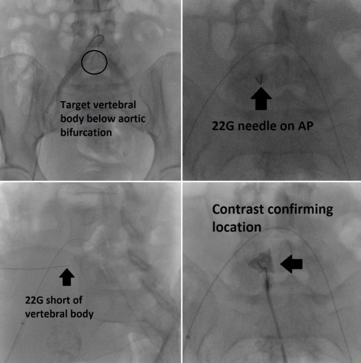 Hypogastric Nerve Block