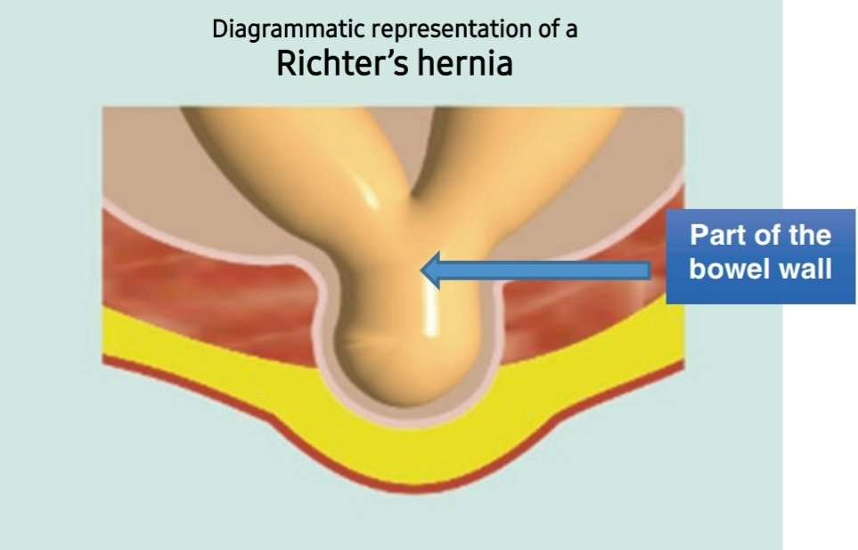 Richters Hernia
