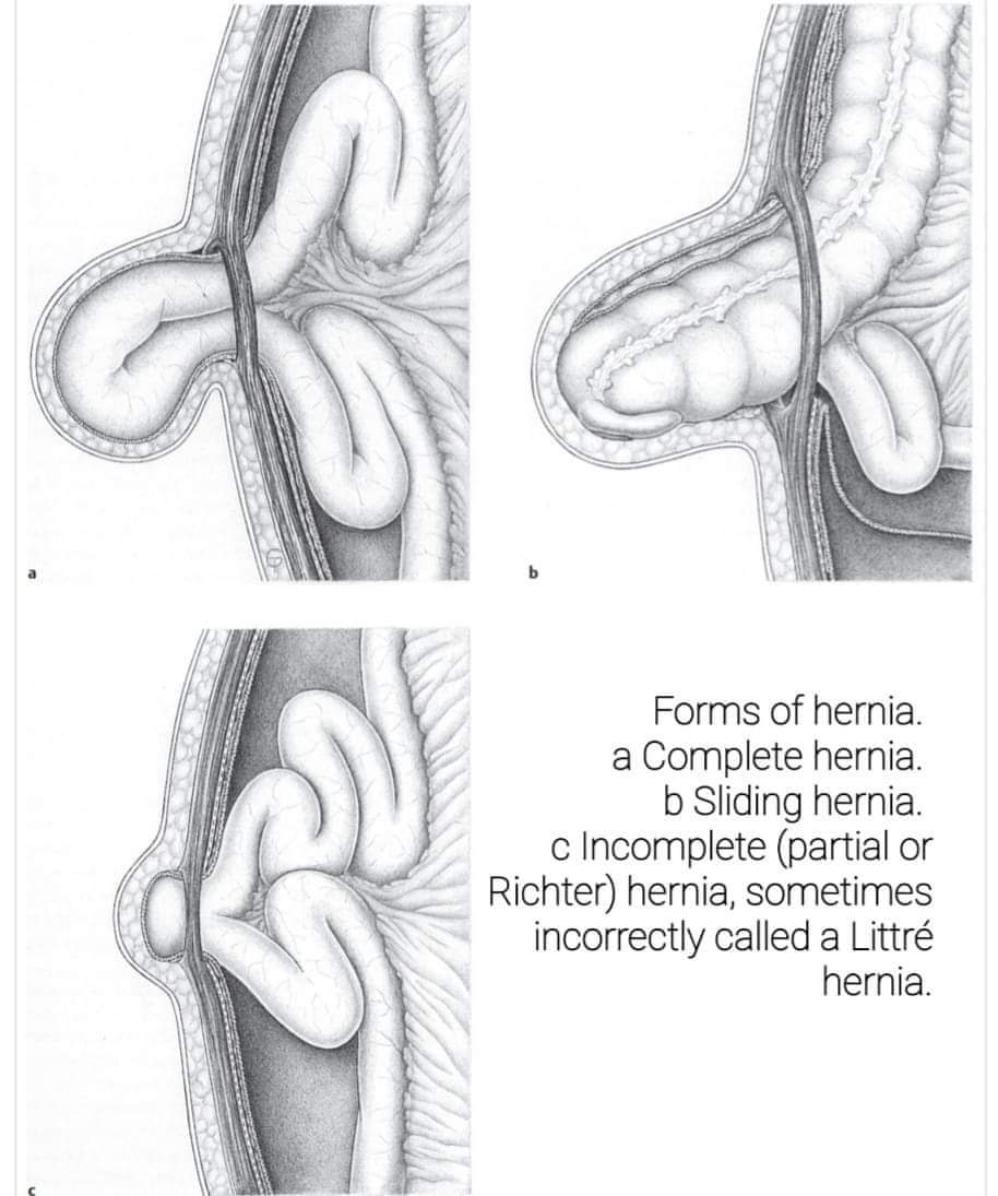 Richter Hernia
