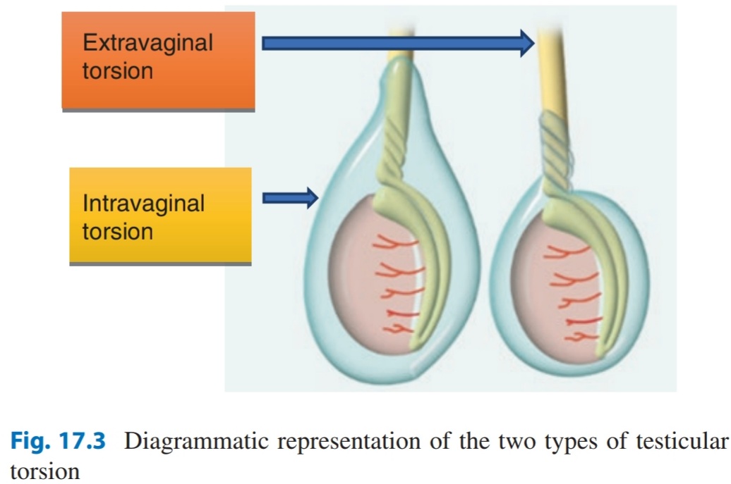 Testicular Torsion Intravaginal