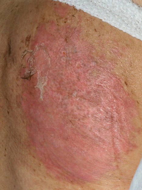 Diffuse Erythematous Rash