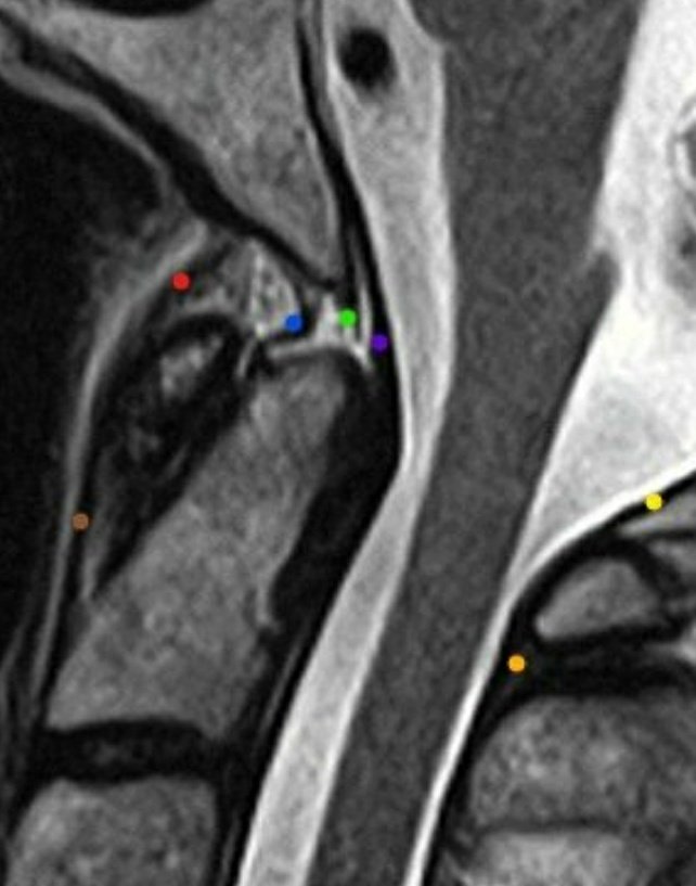 Tectorial Membrane Mri