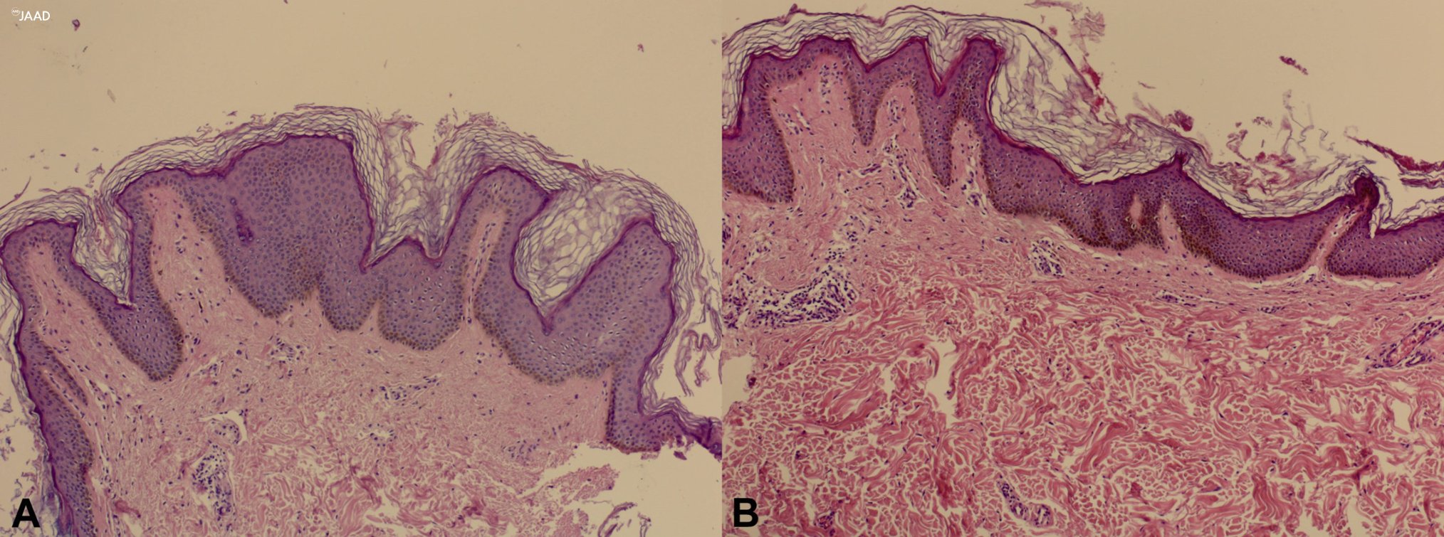 Acanthosis Histology