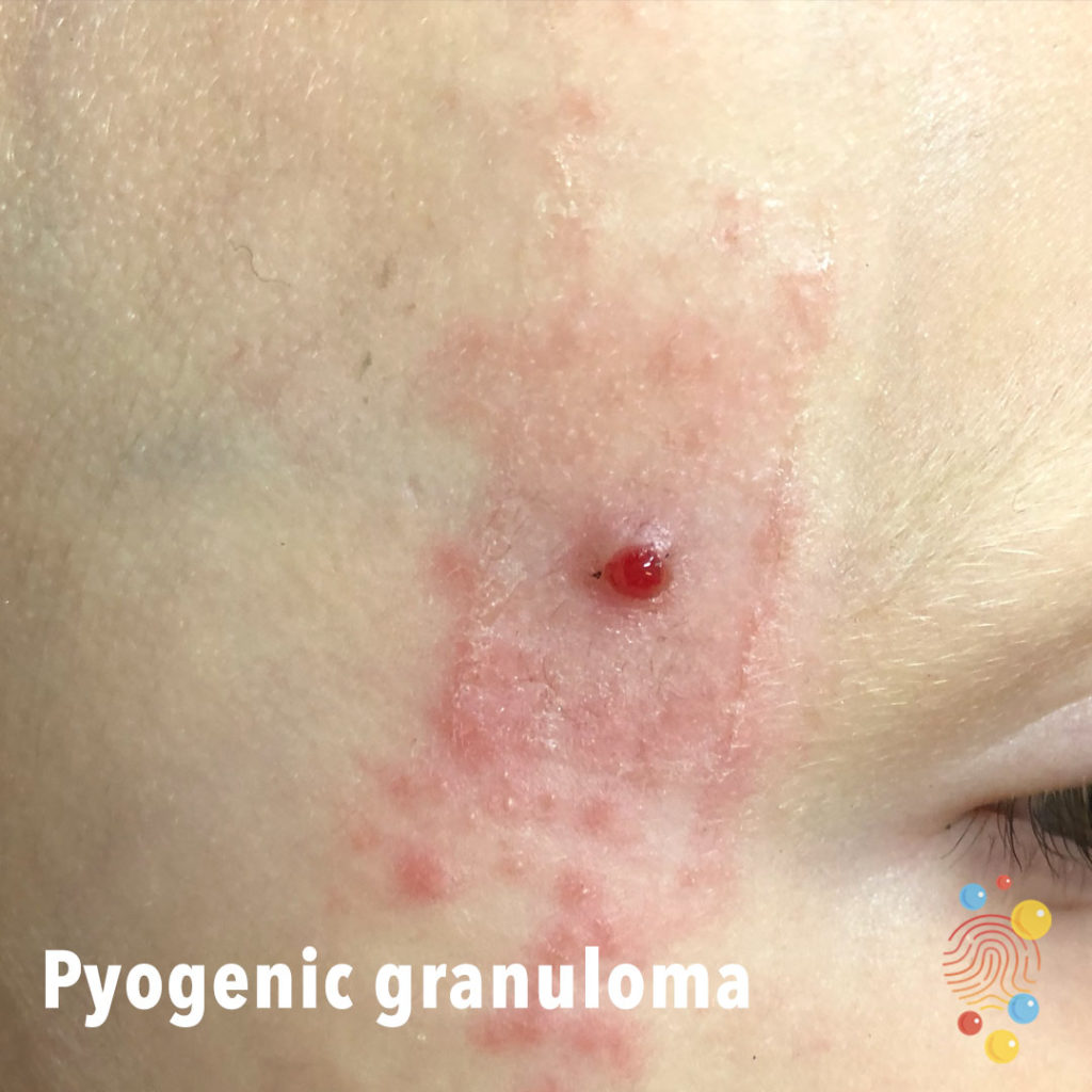 Pyogenic Granuloma Nose