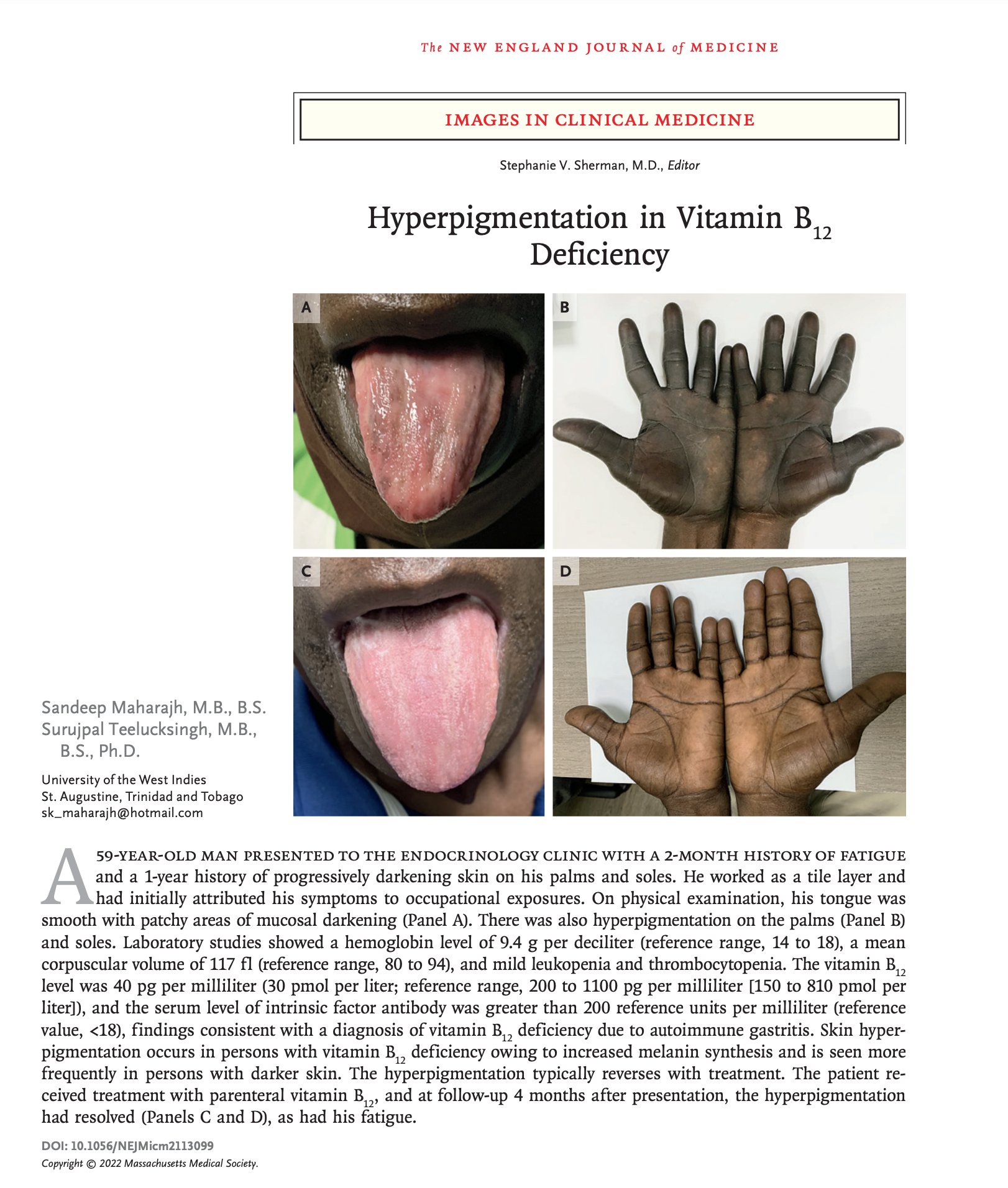 Vitamin B12 Deficiency Rash Testing For Vitamin B12 Deficiency