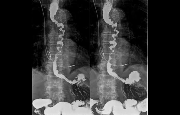 Diffuse Esophageal Spasm Barium Swallow