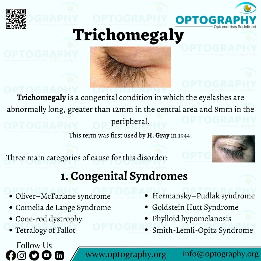 Long Eyelashes Syndrome