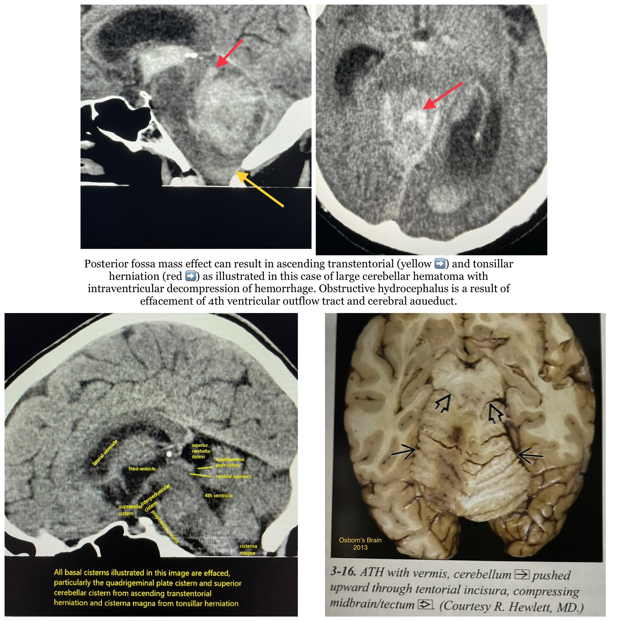 Tentorial Herniation Transtentorial Herniation | Radiology Reference