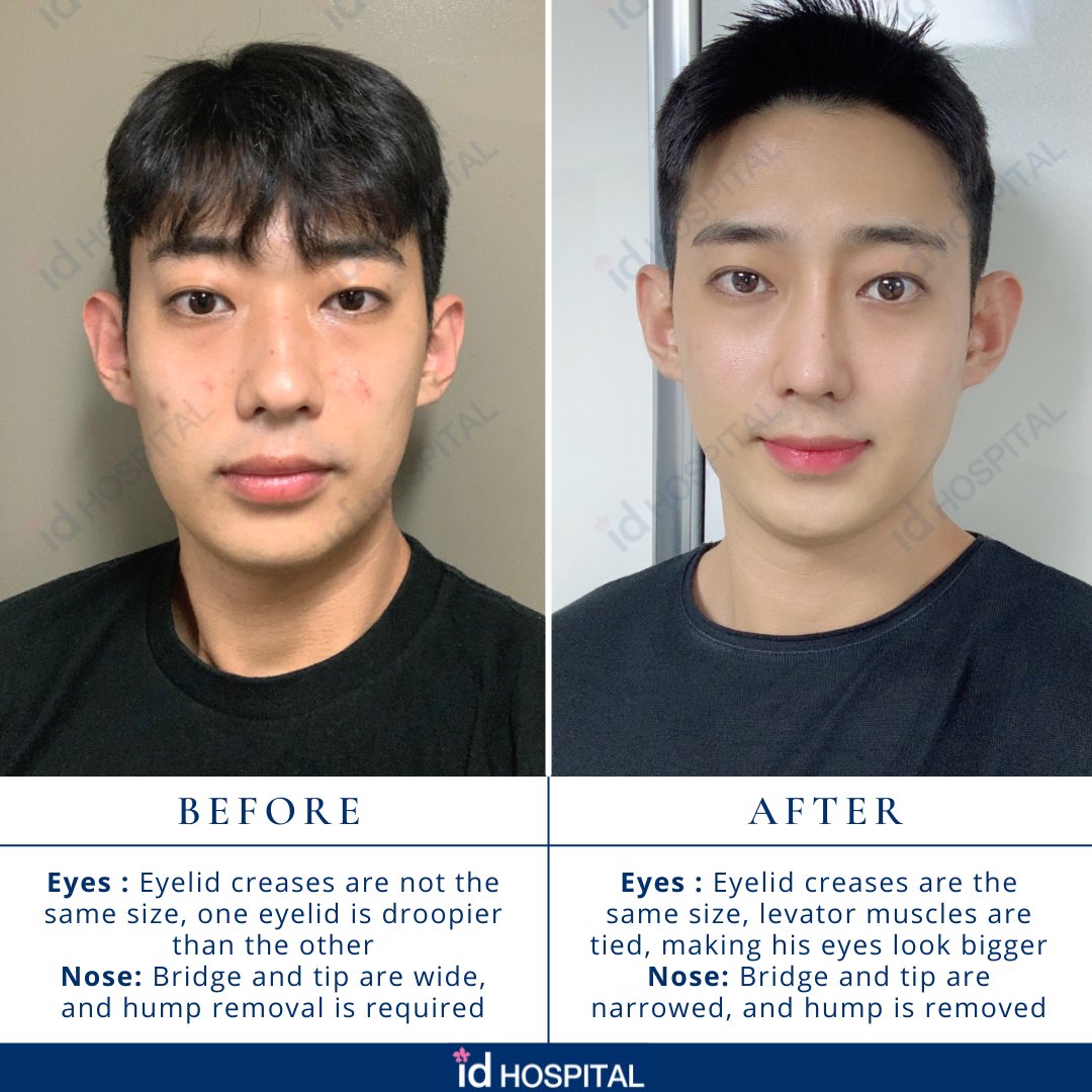Korean Nose Job Men