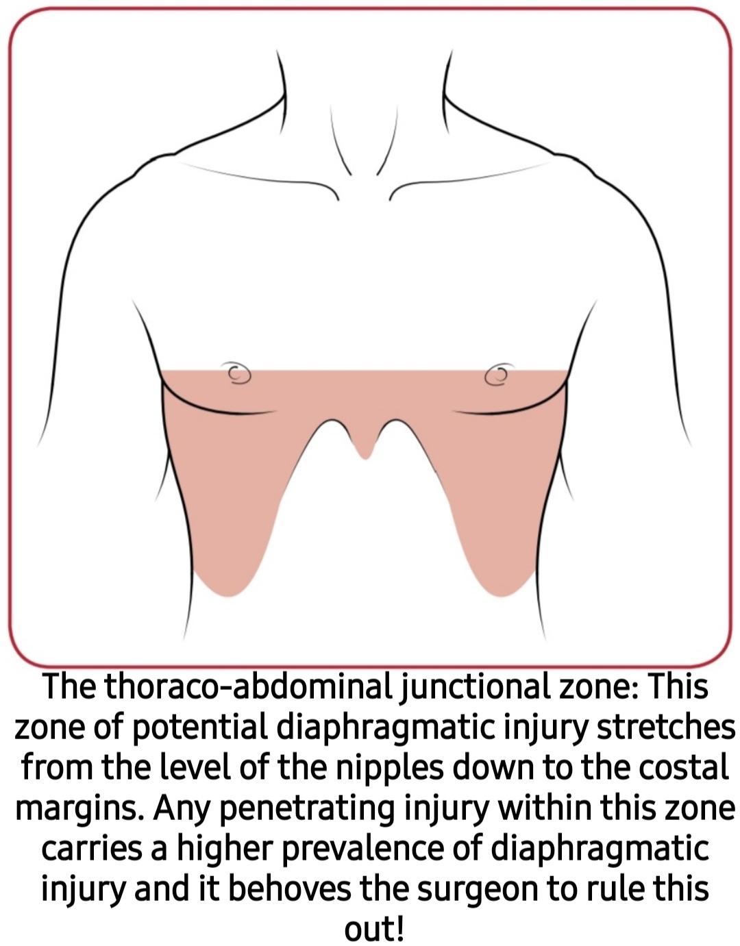 Abdominal Trauma Zones