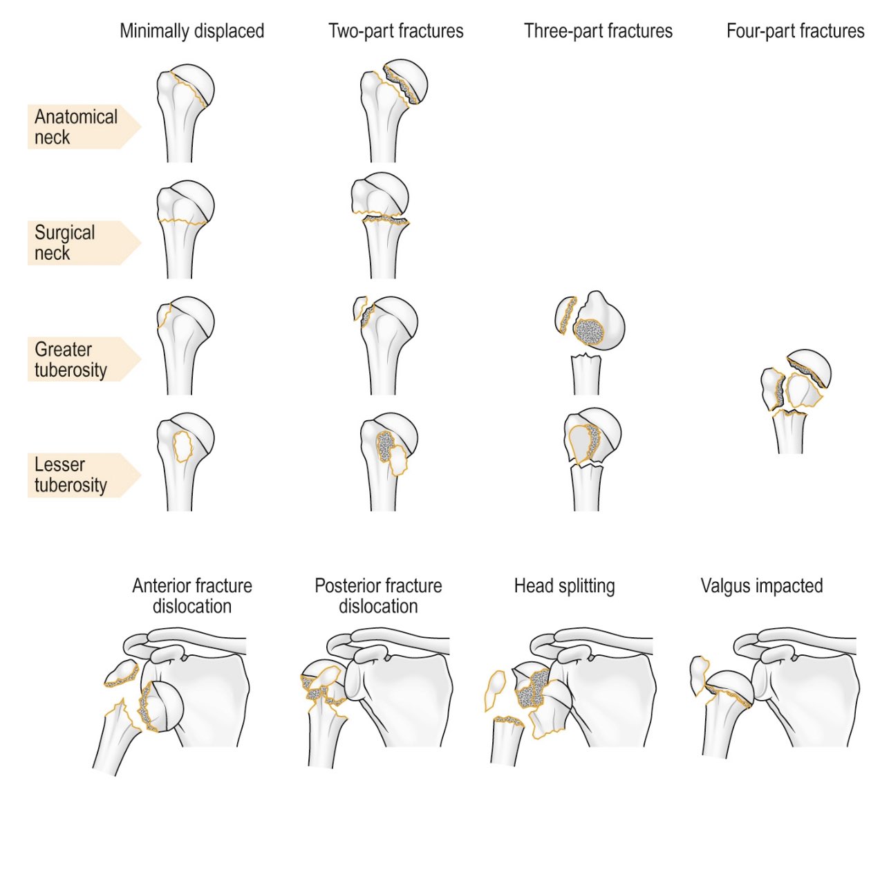 Neer Classification Proximal Humerus Fracture | My XXX Hot Girl Neer Classification Proximal Humerus Fracture | My XXX Hot Girl