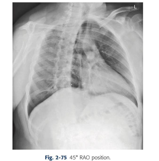 Right Anterior Oblique Chest X Ray Chest X Ray (Chest Radiography)