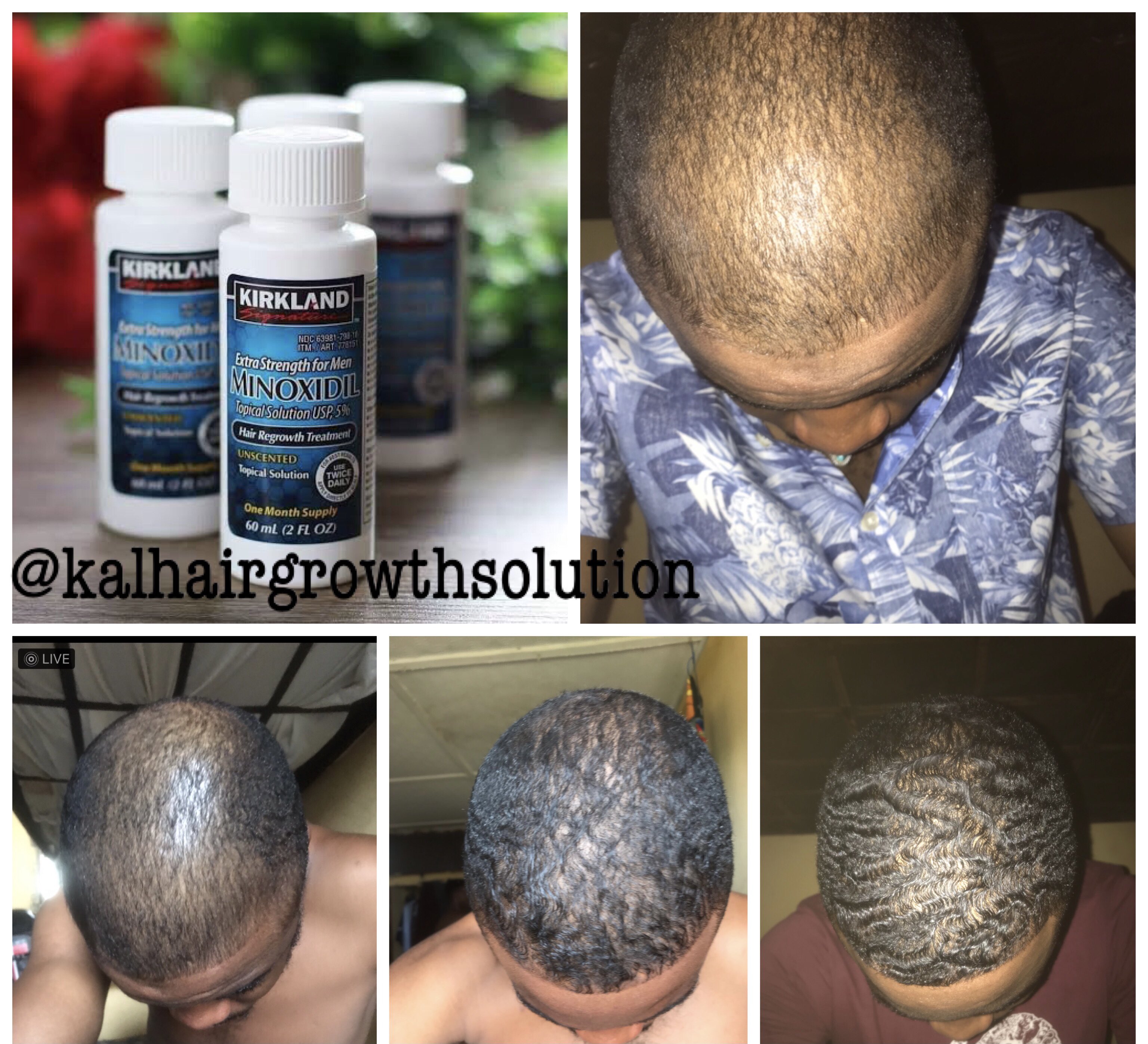 Kirkland minoxidil review store