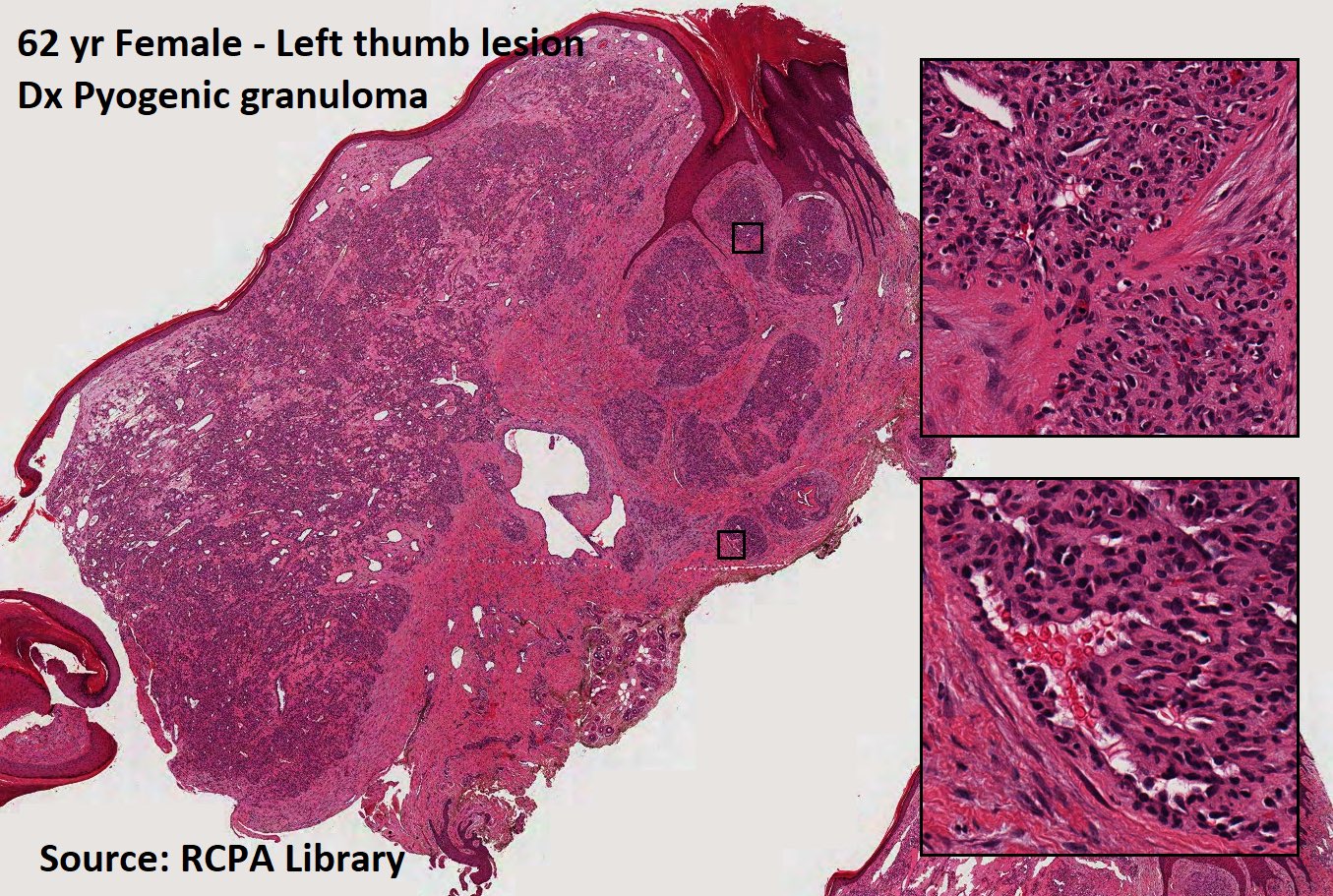 Pyogenic Granuloma Histology