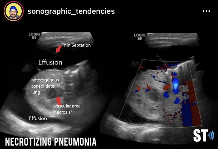 Necrotizing Pneumonia