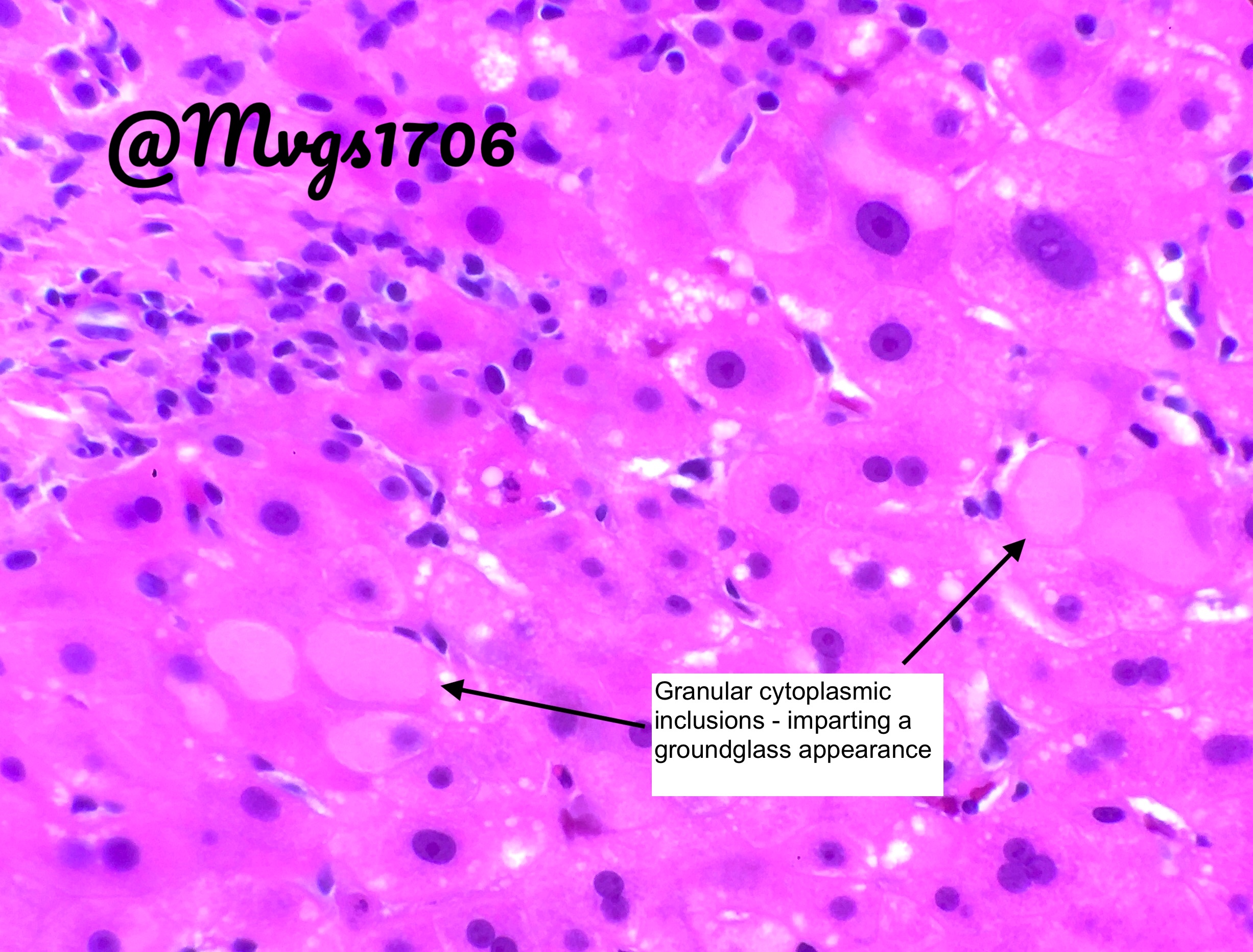 Hepatitis B Ground Glass Hepatocytes