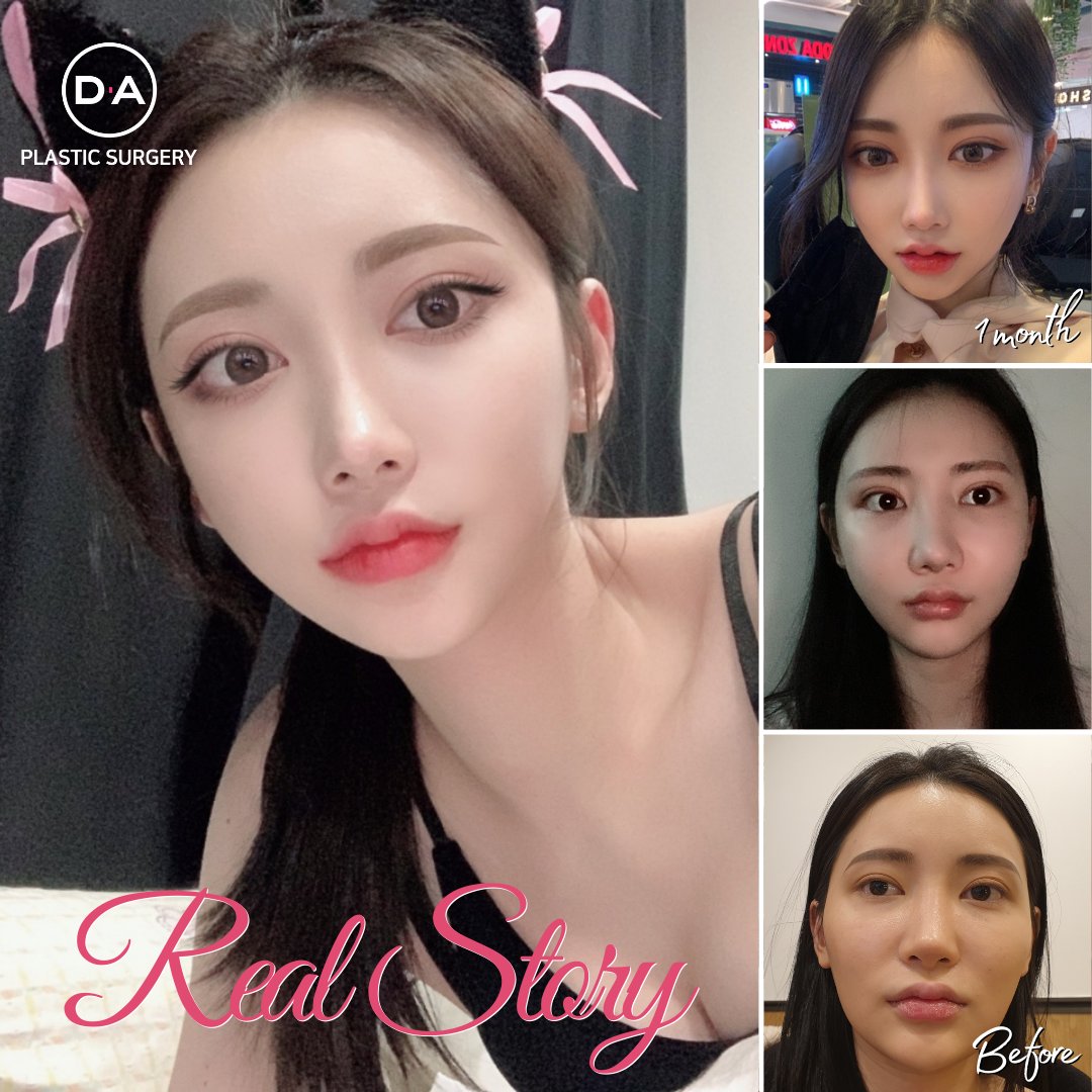 Korean Plastic Surgery Before And After Eyes