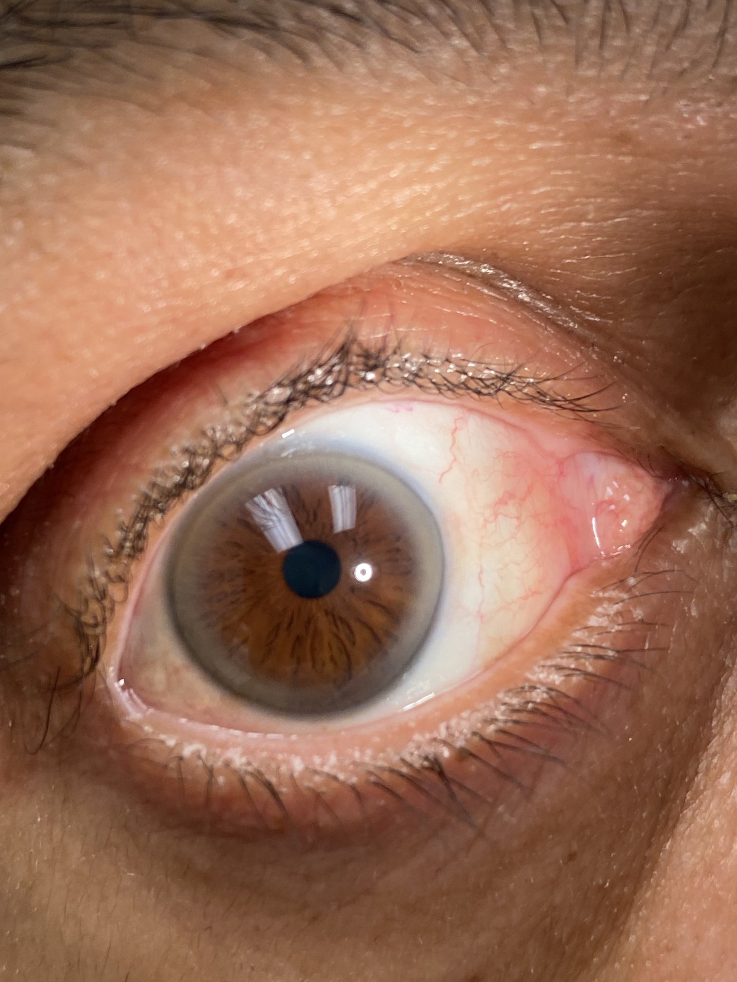 Corneal Arcus