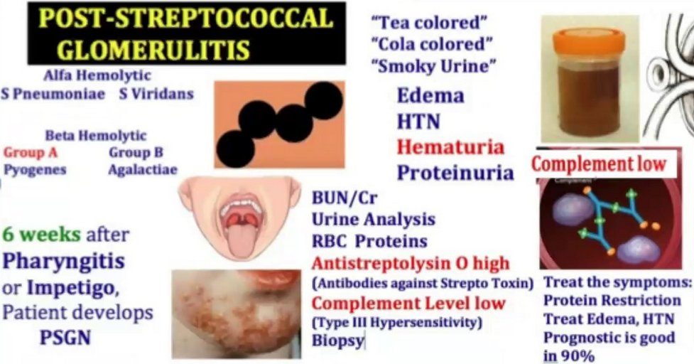 Glomerulonephritis Urine