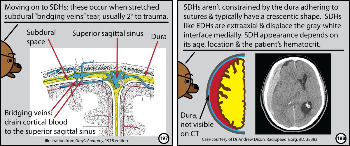 Subdural Hematoma Bridging Veins