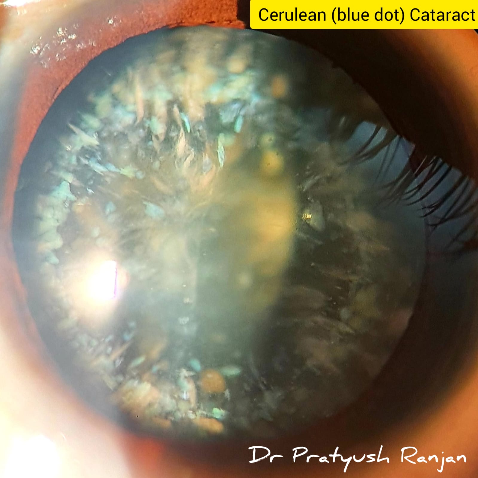 Blue Dot Cataract