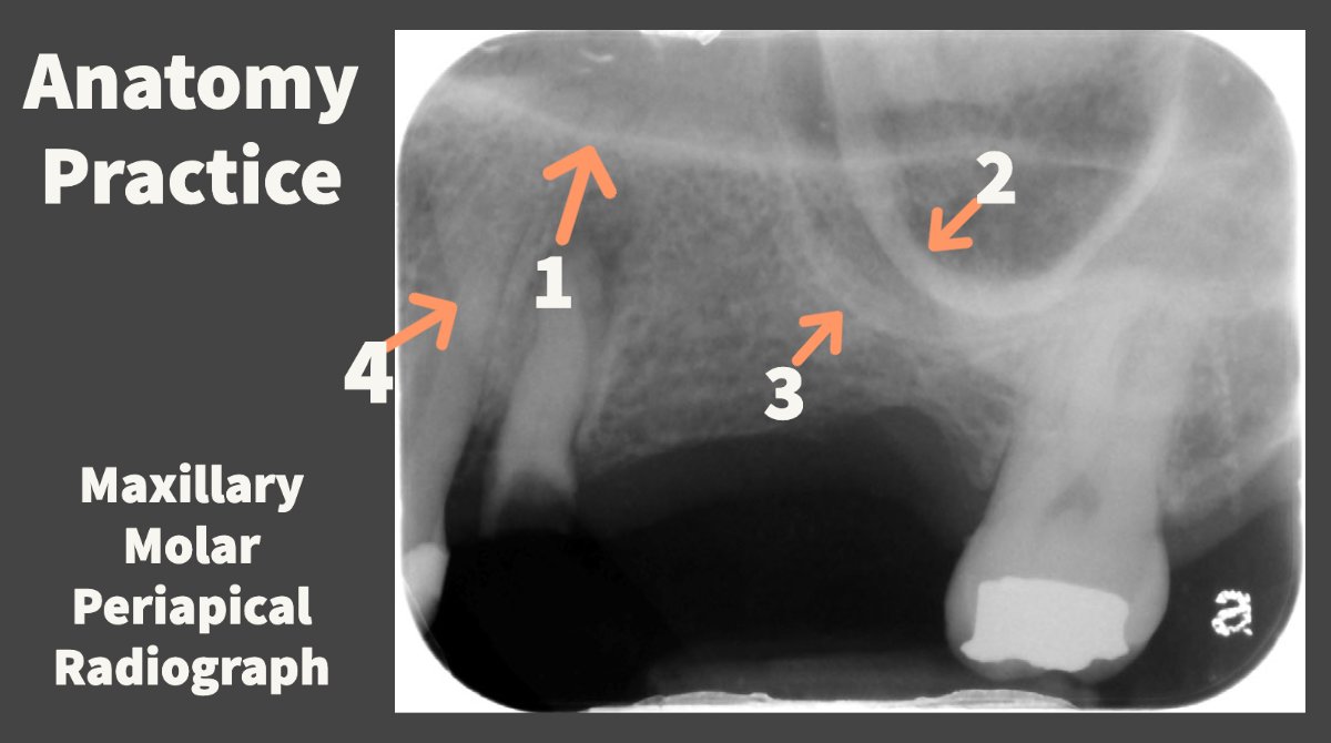 Zygomatic Process Of The Maxilla Radiograph