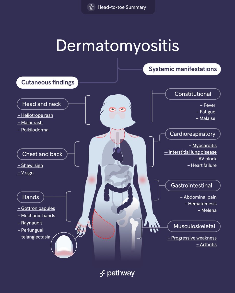 V Sign Dermatomyositis