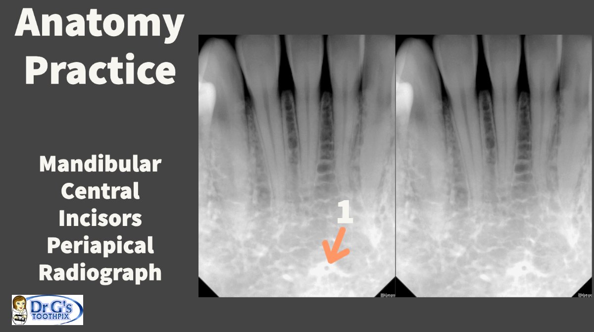 Lingual Foramen Radiograph