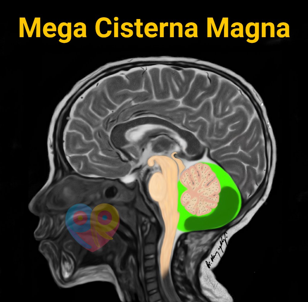 Mega Cisterna Magna Pediatric Radiology