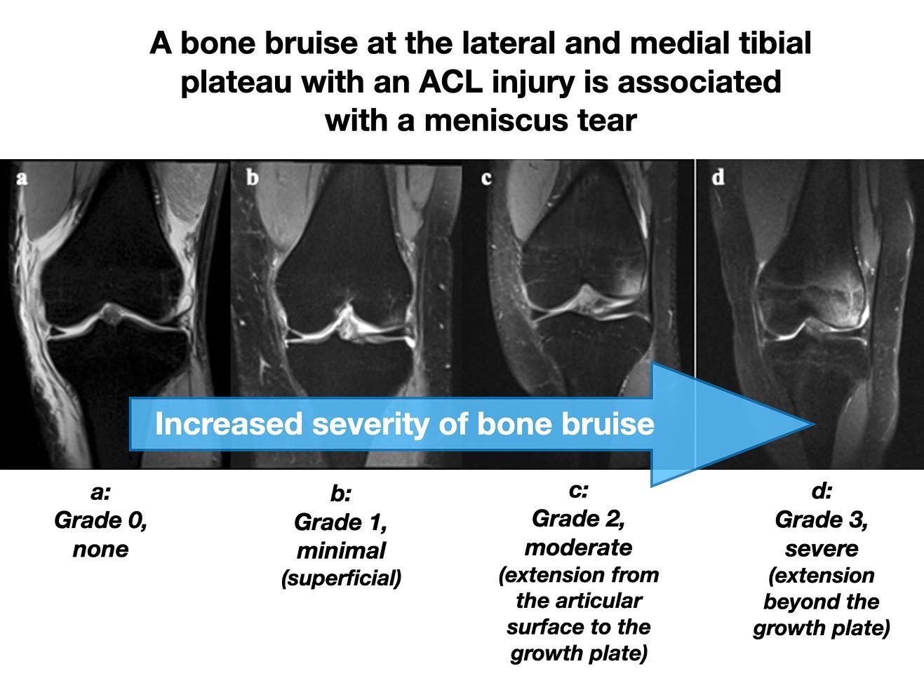 Bone Bruise Knee Mri