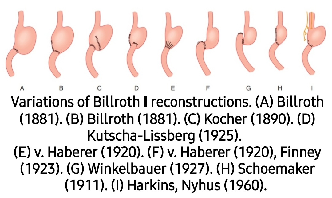 Billroth 1 Functional Outcomes Of Billroth I Gastroduodenostomy Using