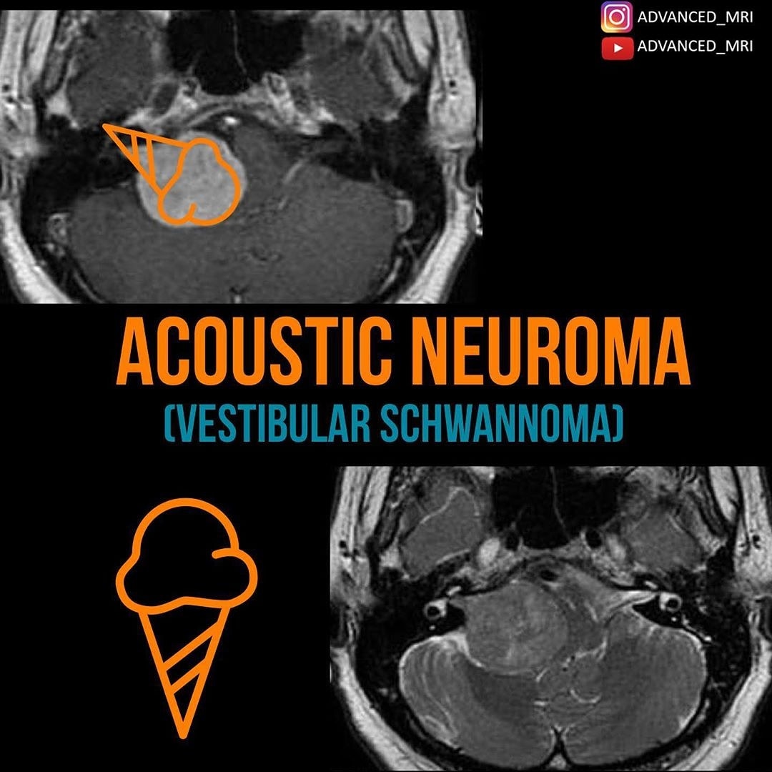 Cerebellopontine Angle Mri