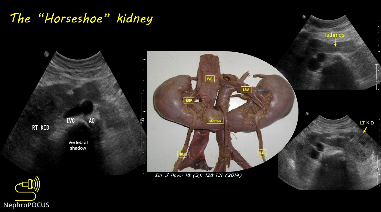 Horseshoe Kidney On Ultrasound Anatomy