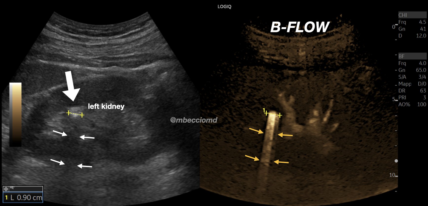What Do Kidney Stones Look Like On Ultrasound