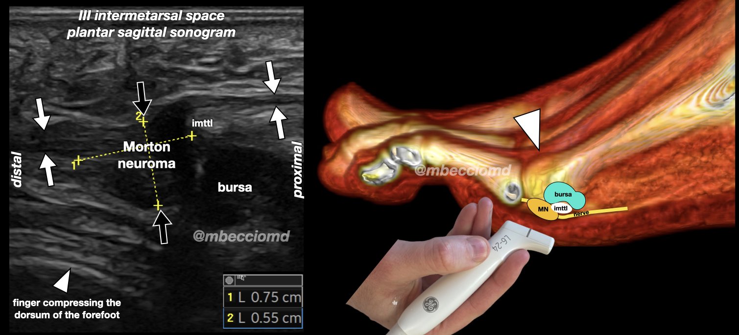 Mortons Neuroma Ultrasound