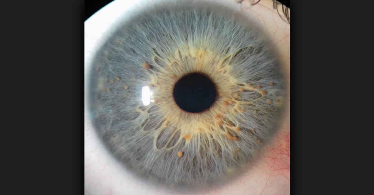 Neurofibromatosis Type 1 Eye