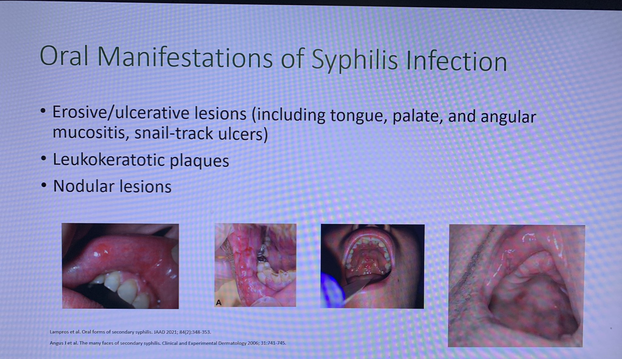 Syphilis Snail Track Ulcers