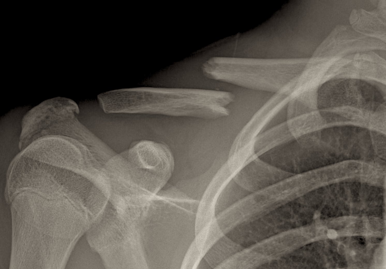 Clavicle Fracture Xray