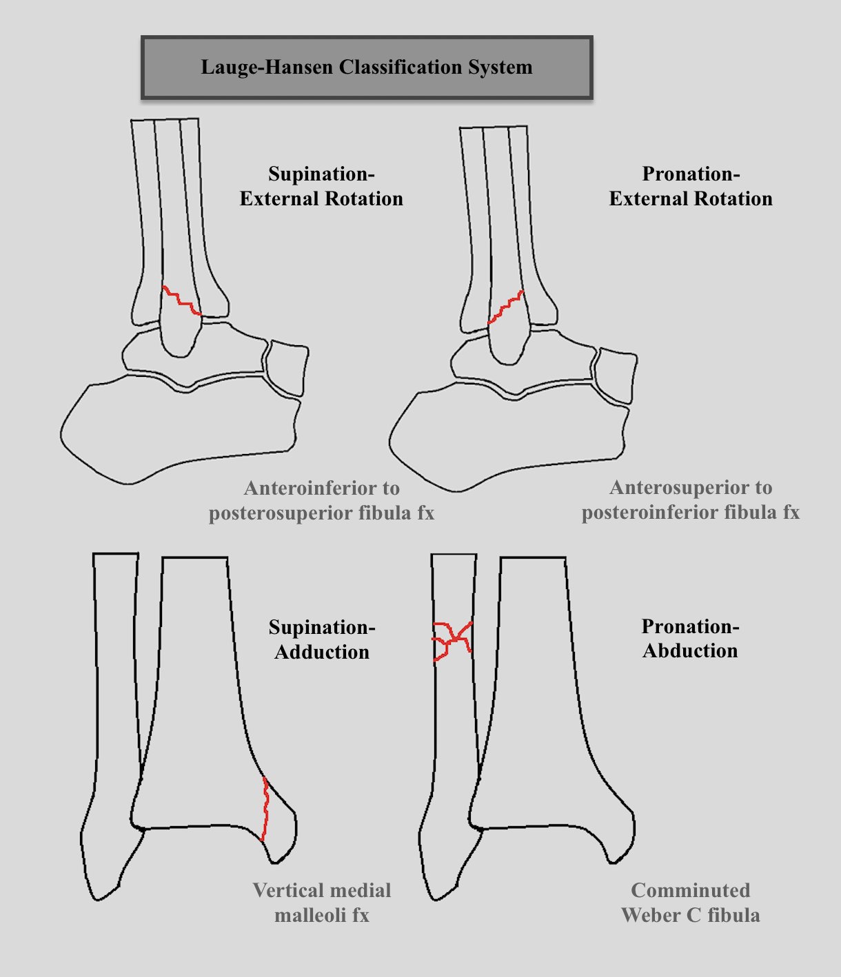 Pronation Abduction Ankle Fracture