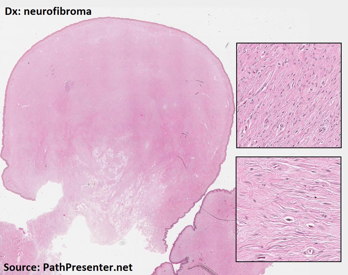 Plexiform Neurofibroma Histology