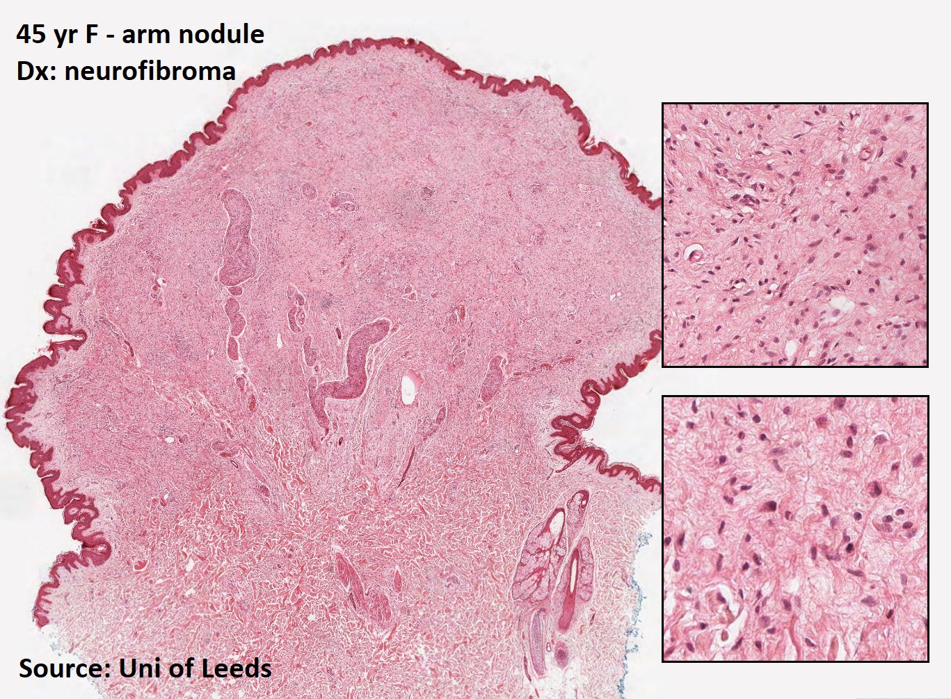 Plexiform Neurofibroma Histopathology