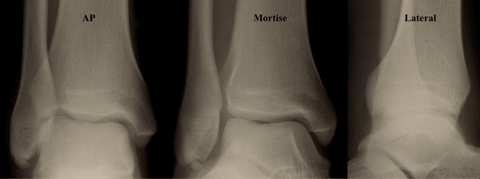 Ap Ankle X Ray Anatomy