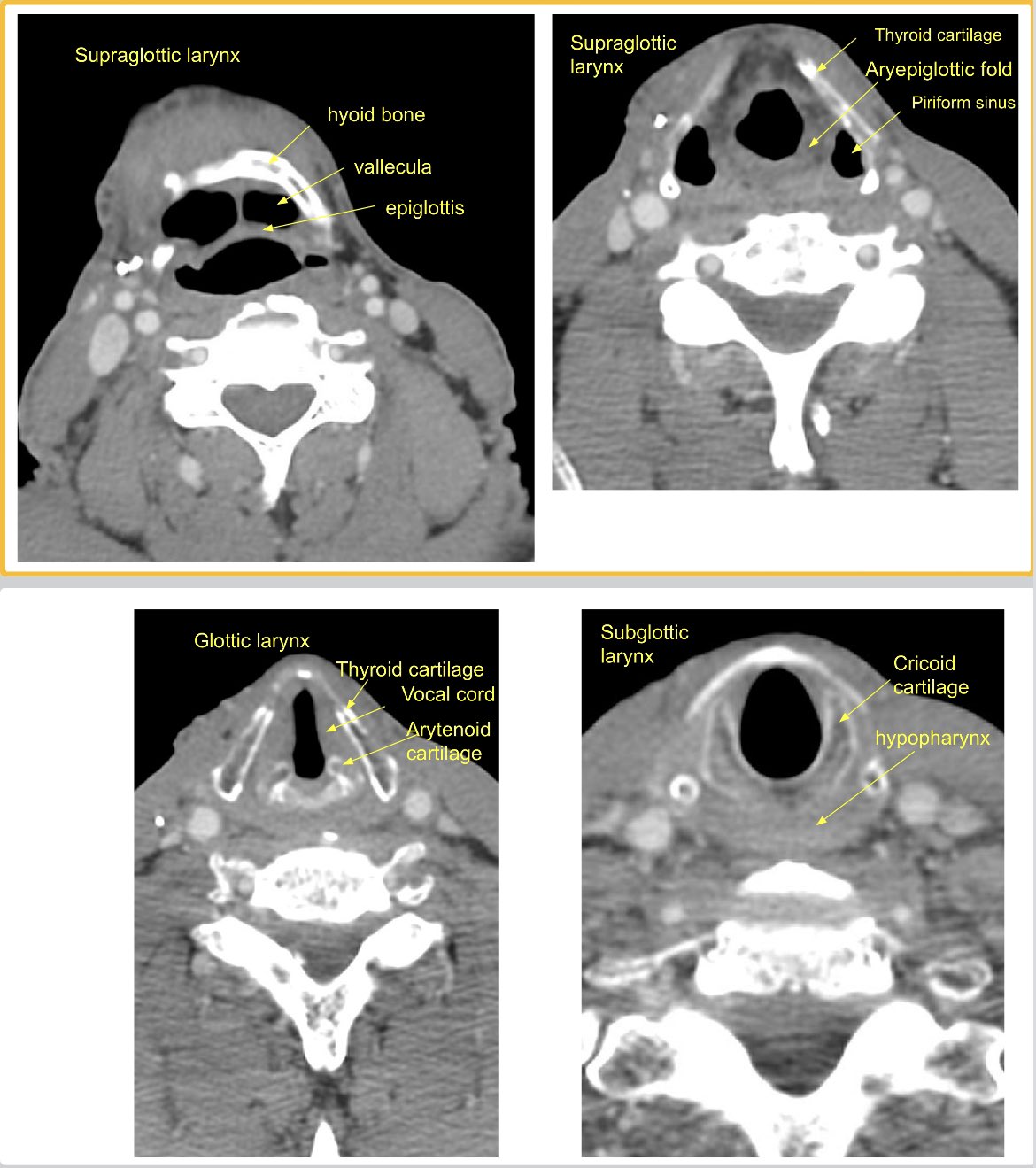 Subglottic Area Anatomy